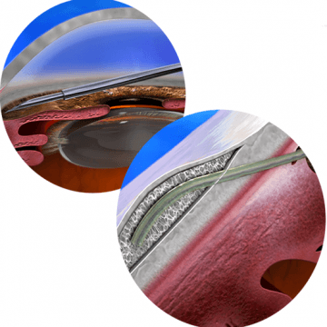 Glaucoma Eye Treatment & Surgery Melbourne - Heidelberg Eye Clinic